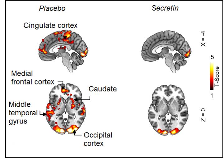 fMRI images showing diminished [IMAGE] | EurekAlert! Science News Releases
