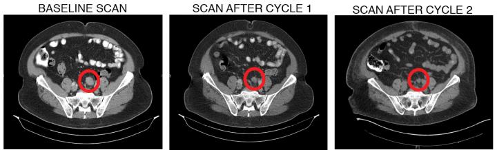 Lessons from a Lung Cancer Therapy Could Help | EurekAlert!