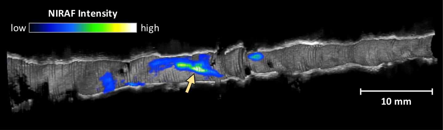 OCT-NIRAF Imaging of Coronary [IMAGE] | EurekAlert! Science News Releases