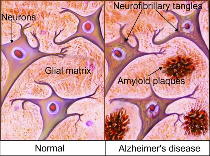 Normal vs Alzheimer's Disease [IMAGE] | EurekAlert! Science News Releases
