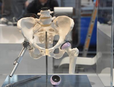 Hip implant for long-term use | EurekAlert!