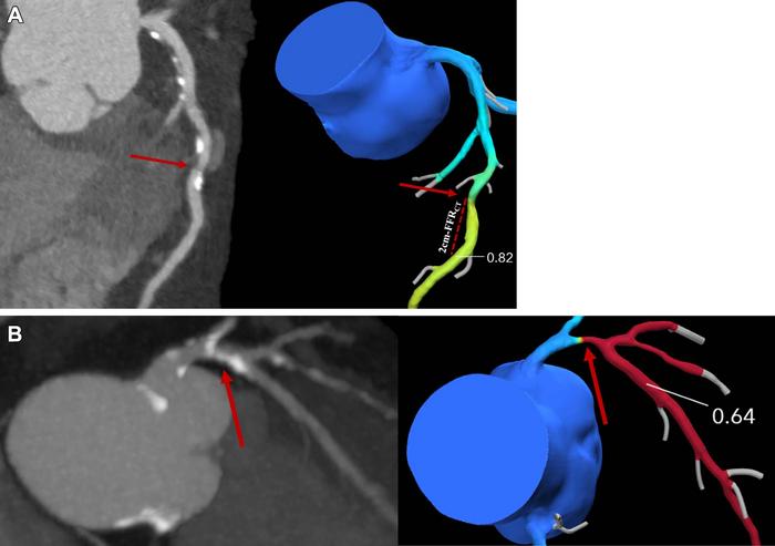 CT test simulates blood flow to assess risk i | EurekAlert!