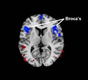 Broca's Area, Located in the F [IMAGE] | EurekAlert! Science News Releases