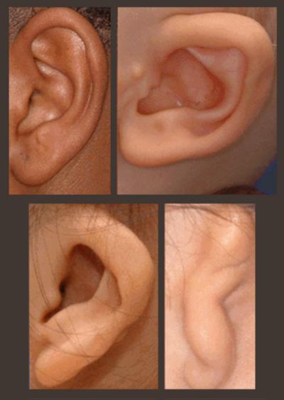 External Ear Malformation [IMAGE] | EurekAlert! Science News Releases