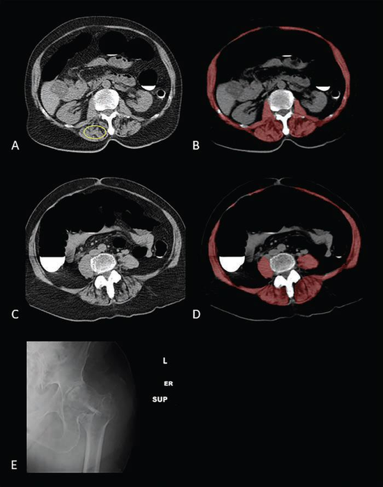 Sarcopenia (Myosteatosis) at S [IMAGE] | EurekAlert! Science News Releases