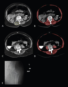 Deep learning tool for sarcopenia on CT: L1 v | EurekAlert!