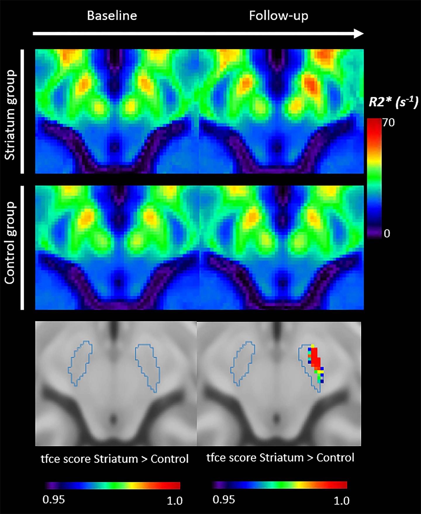 Iron Measurements with MRI Rev [IMAGE] | EurekAlert! Science News Releases