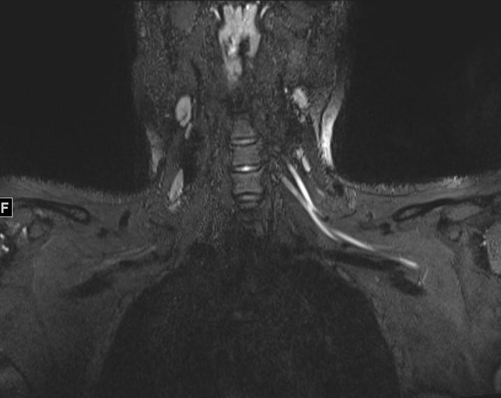MRI Shows Nerve Damage From CO IMAGE EurekAlert Science News Releases