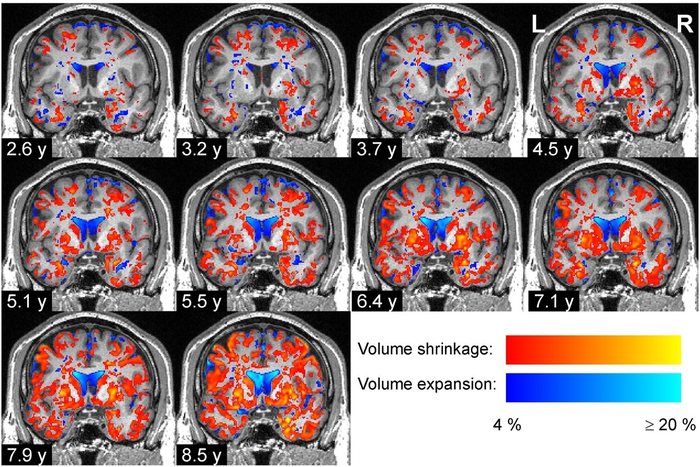 Degeneration of brain tissue [IMAGE] | EurekAlert! Science News Releases