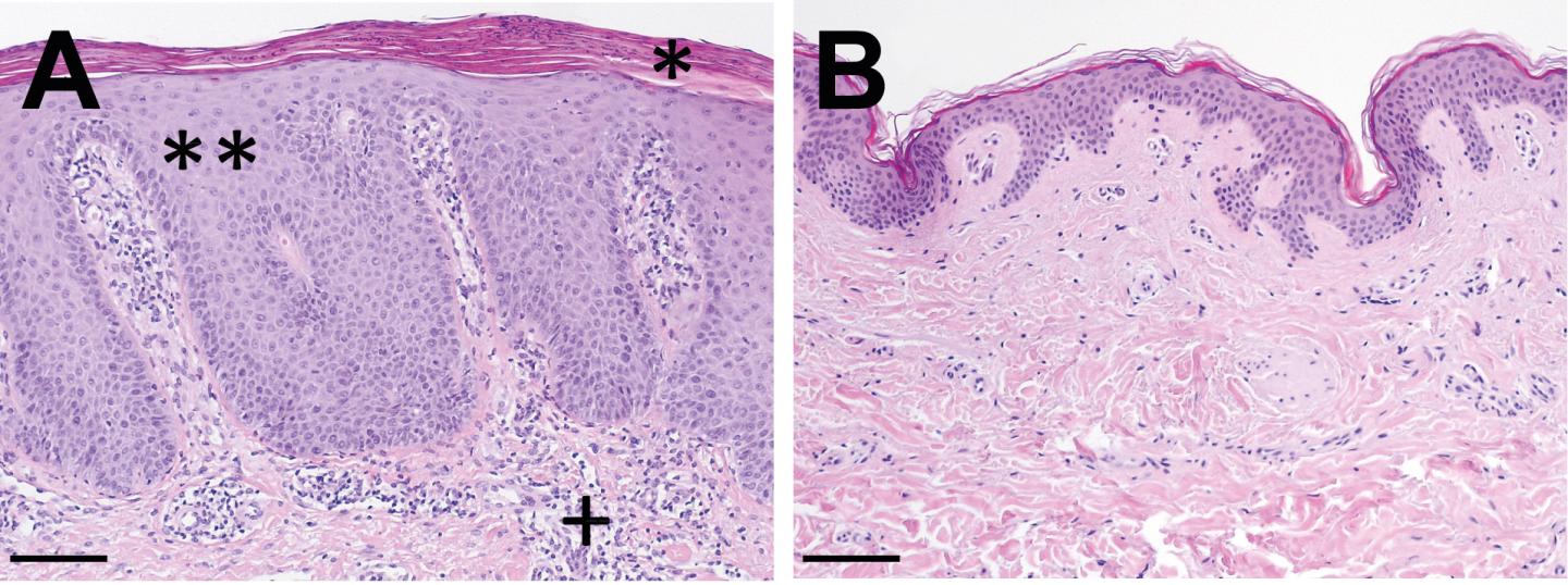 Psoriasis: Light shed on new details | EurekAlert!