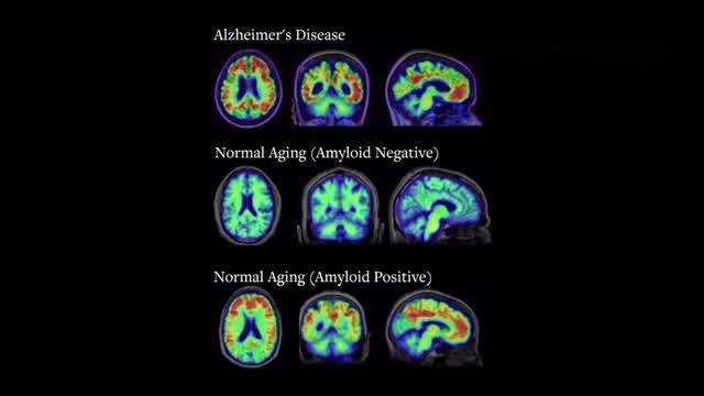 PET scans reveal key details of Alzheimer's p | EurekAlert!