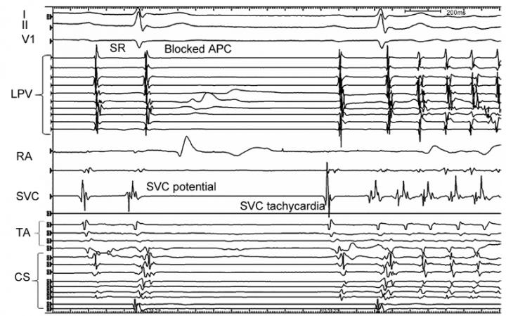 Superior vena cava(SVC)-derived atrial fibril | EurekAlert!