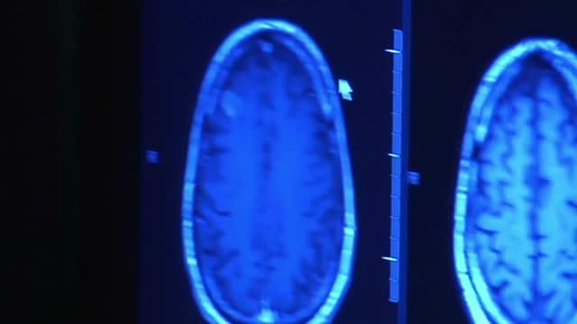 How a woman with amnesia defies conventional | EurekAlert!