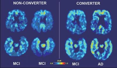 Brain Images Converting MCI to [IMAGE] | EurekAlert! Science News Releases