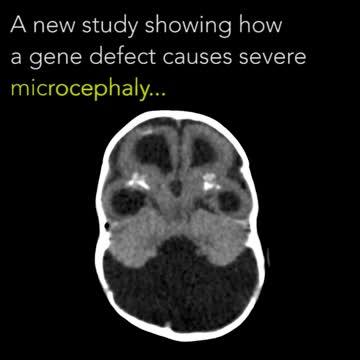 In some genetic cases of microcephaly, stem c | EurekAlert!