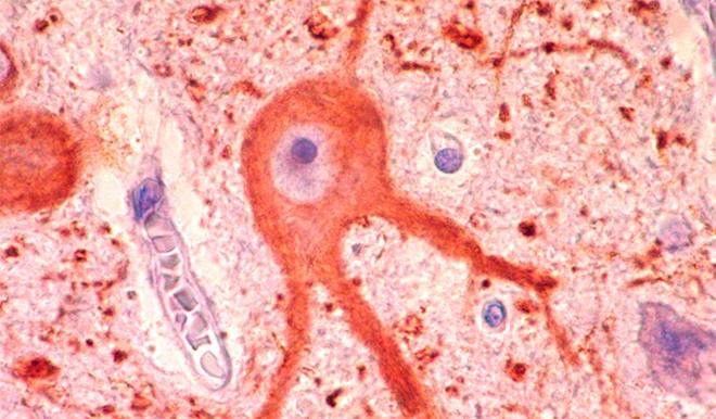 A Dysmorphic Neuron Stained wi [IMAGE] | EurekAlert! Science News Releases