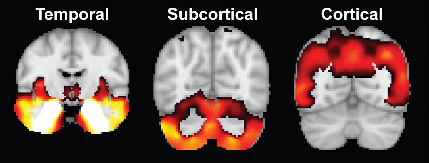 Different brain atrophy patterns may explain | EurekAlert!