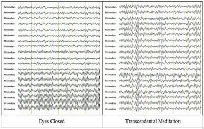 Comparative EEG Tracings [IMAGE] | EurekAlert! Science News Releases
