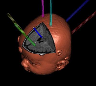 Gene Therapy for Canavan Disea [IMAGE] | EurekAlert! Science News Releases