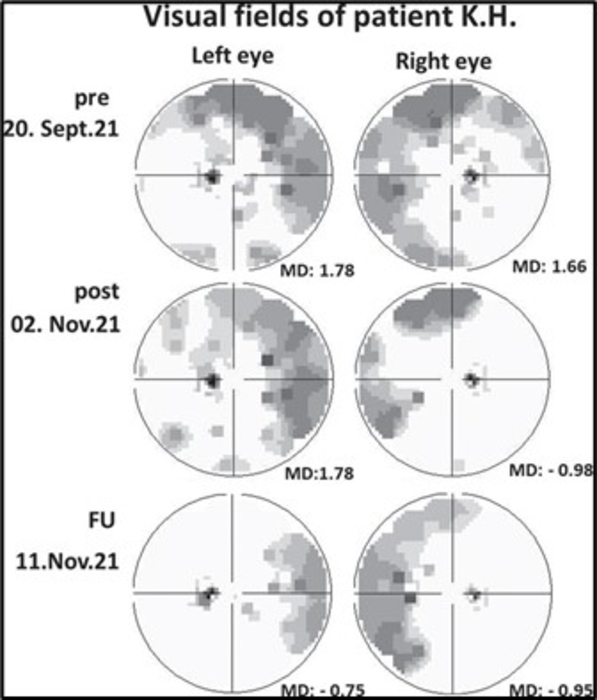 Brain stimulation rapidly improves cognitive | EurekAlert!