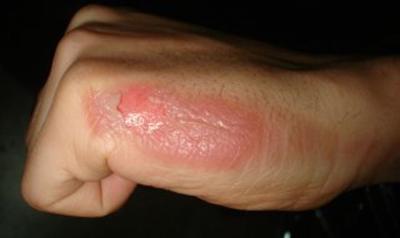 Skin Burn [IMAGE] | EurekAlert! Science News Releases