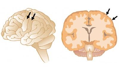 Fold formation of the cerebral cortex require | EurekAlert!