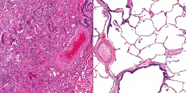 Comparison of Patient's Lung T [IMAGE] | EurekAlert! Science News Releases