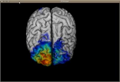 Cortex Lesions [IMAGE] | EurekAlert! Science News Releases