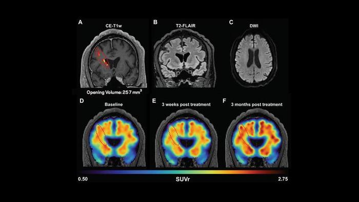 MRI and PET scans of an Alzhei [IMAGE] | EurekAlert! Science News Releases