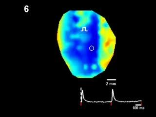Easing the Heart Back to Normal Rhythm (4 of | EurekAlert!