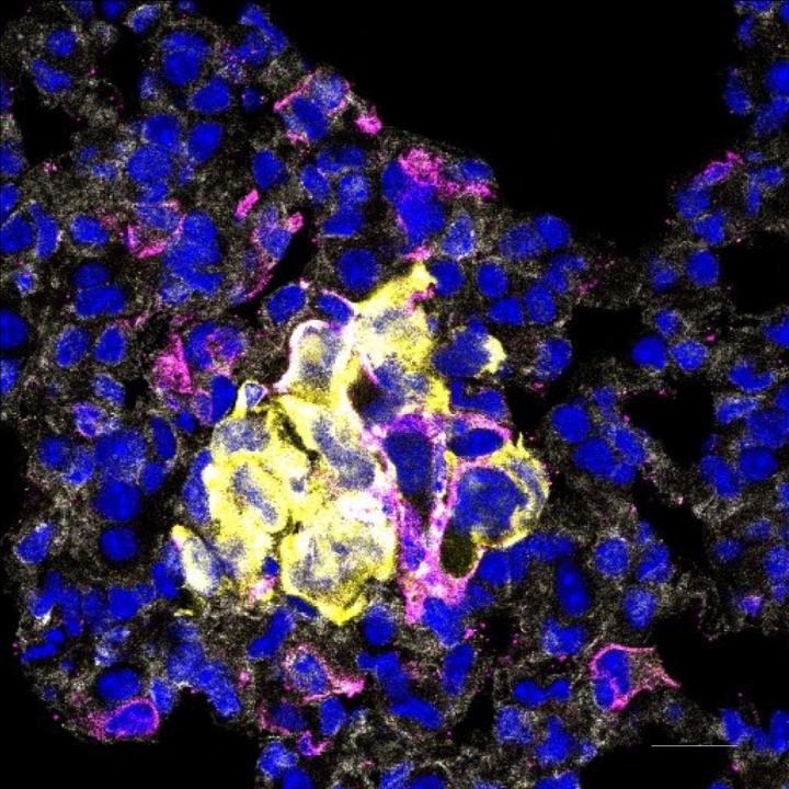 Metastatic Breast Cancer Cells [IMAGE] | EurekAlert! Science News Releases
