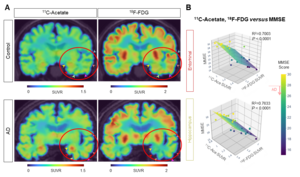 A new breakthrough in Alzheimer disease resea | EurekAlert!