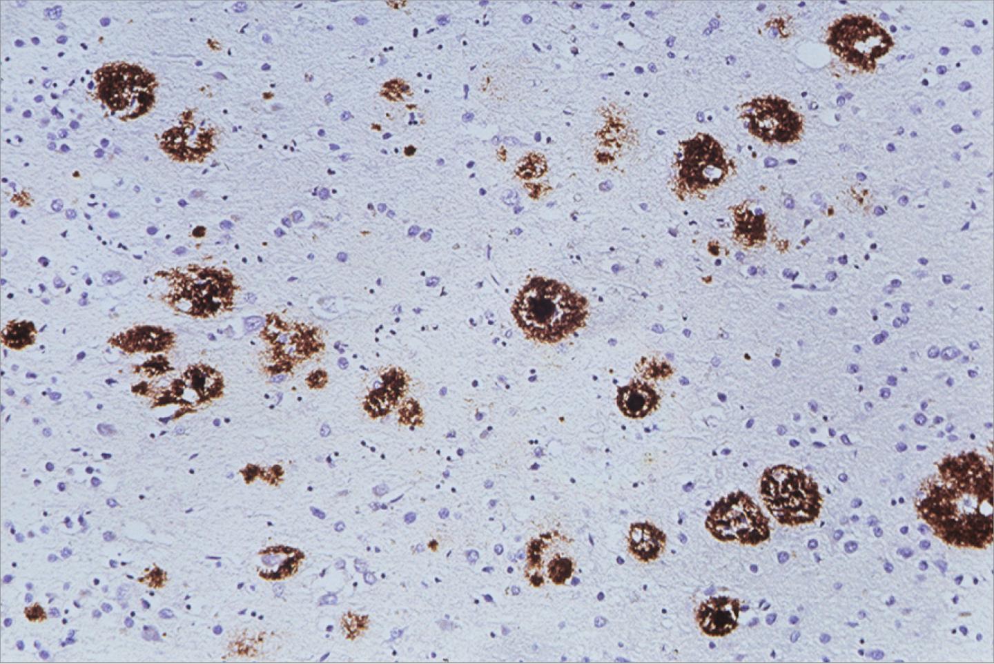Alzheimer-type brain pathology after transpla | EurekAlert!