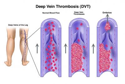 Deep Vein Thrombosis [IMAGE] | EurekAlert! Science News Releases