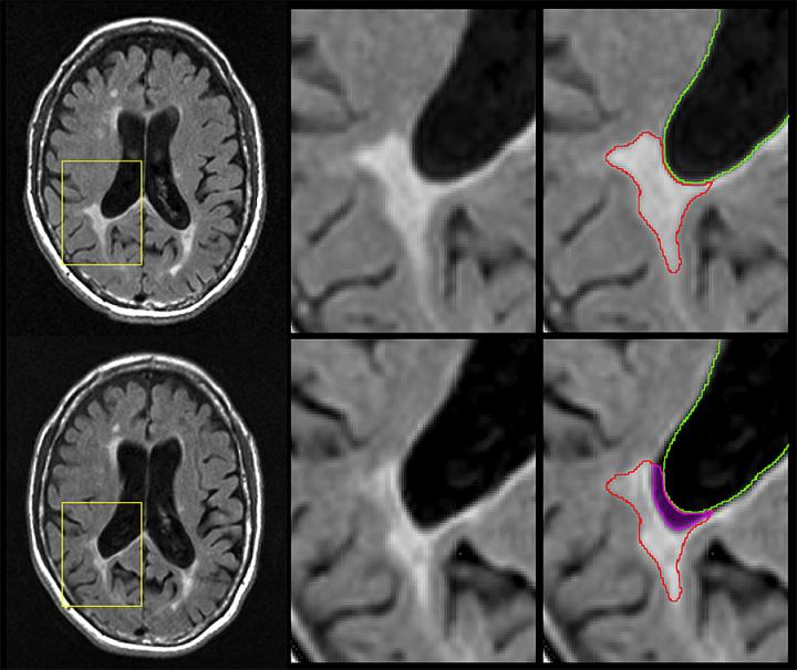 In MS, Disintegrating Brain Le [IMAGE] | EurekAlert! Science News Releases