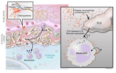 Platelets Stoke the Fire of Rheumatoid Arthri | EurekAlert!