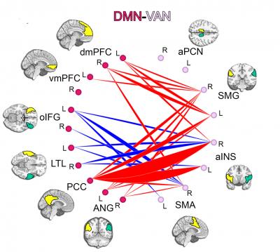 Lagging Brain Connections in A [IMAGE] | EurekAlert! Science News Releases