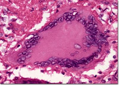 Tuberculosis [IMAGE] | EurekAlert! Science News Releases