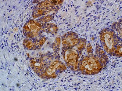 Prostate Cancer's Cellular Ori [IMAGE] | EurekAlert! Science News Releases
