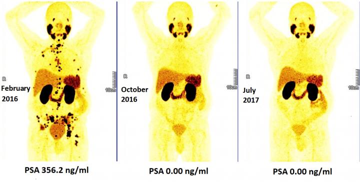 Early treatment of advanced prostate cancer w | EurekAlert!