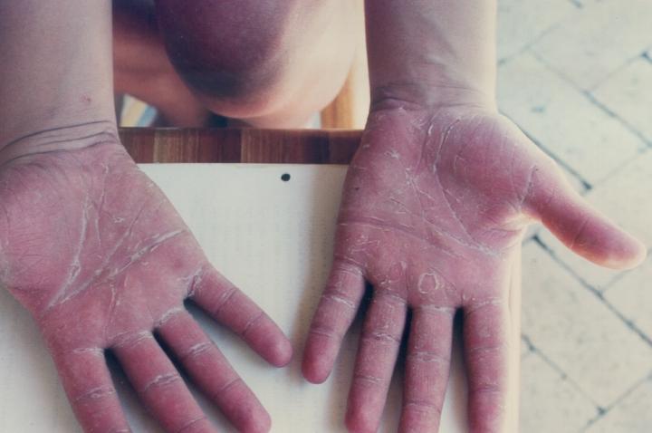 Scientists find genetic mutation responsible | EurekAlert!