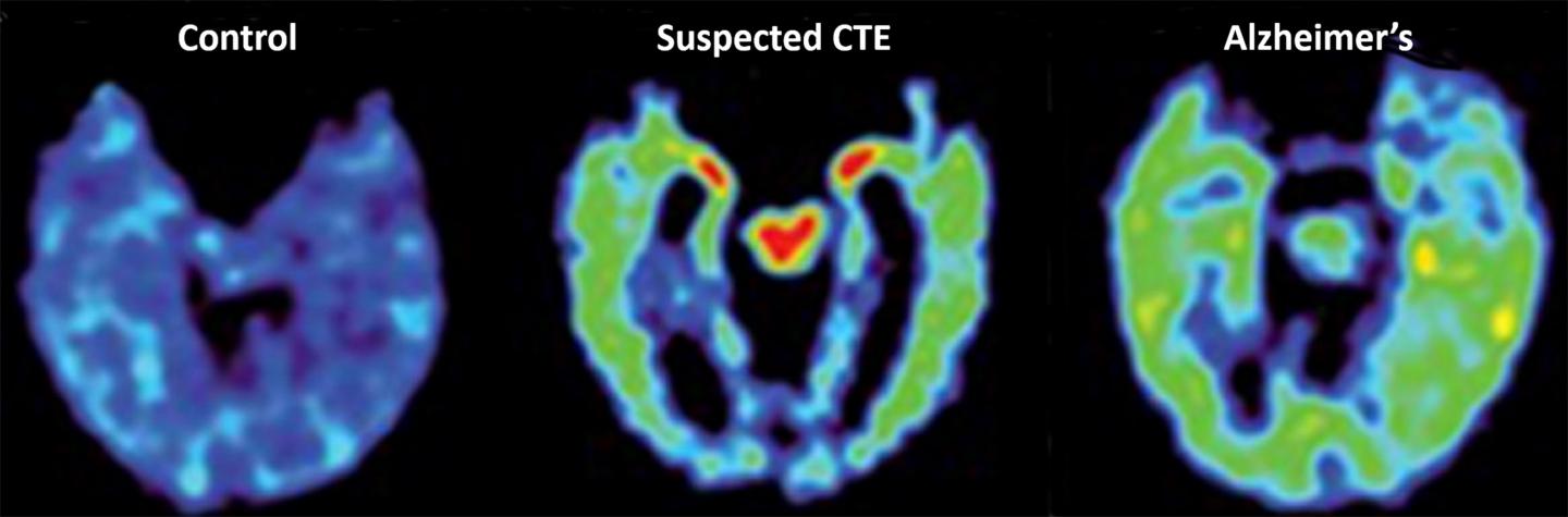 PET Brain Scans [IMAGE] | EurekAlert! Science News Releases