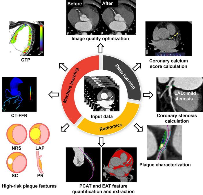 Artificial intelligence helps coronary CT ang | EurekAlert!