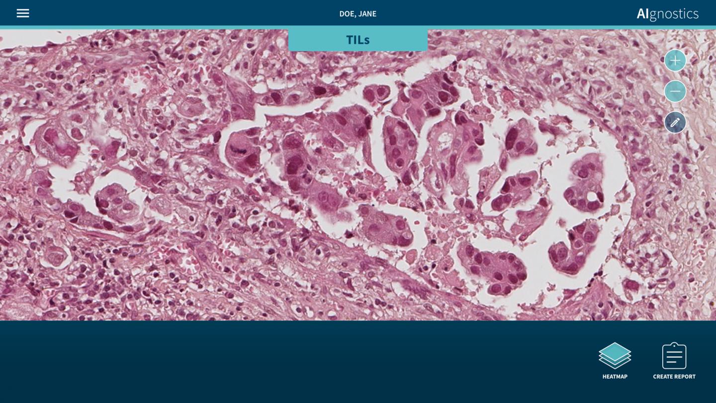 Breast Cancer Tissue Sample [IMAGE] | EurekAlert! Science News Releases