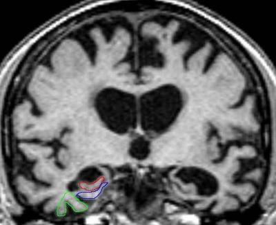 MRI Brain Scan Fig. 2 [IMAGE] | EurekAlert! Science News Releases
