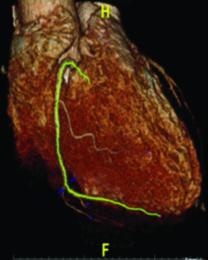Finally, a Noninvasive Measure to Identify Da | EurekAlert!