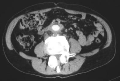 Inflammatory Tissue TC Scan [IMAGE] | EurekAlert! Science News Releases