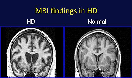 MRI of HD Brain [IMAGE] | EurekAlert! Science News Releases