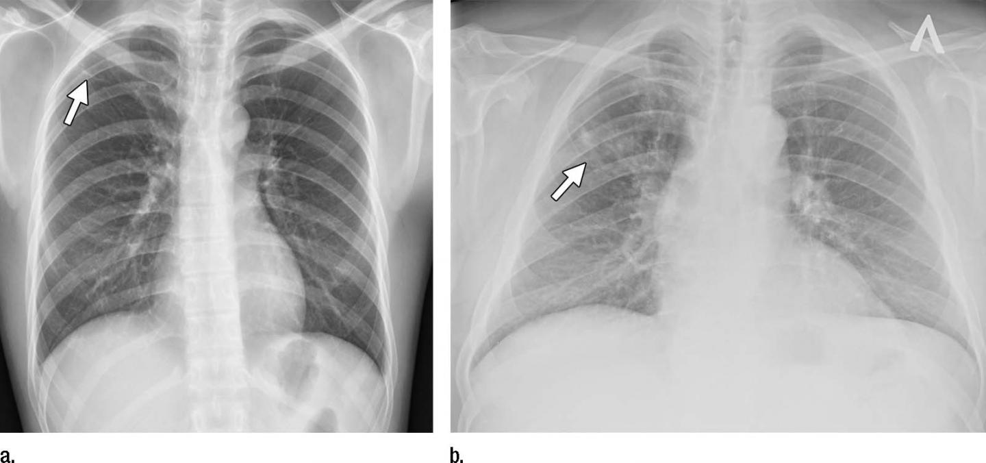 Radiographs [IMAGE] | EurekAlert! Science News Releases