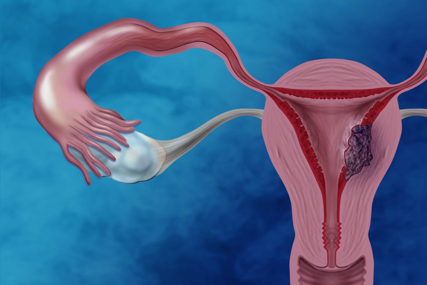Endometrial Tumor Study [IMAGE] | EurekAlert! Science News Releases